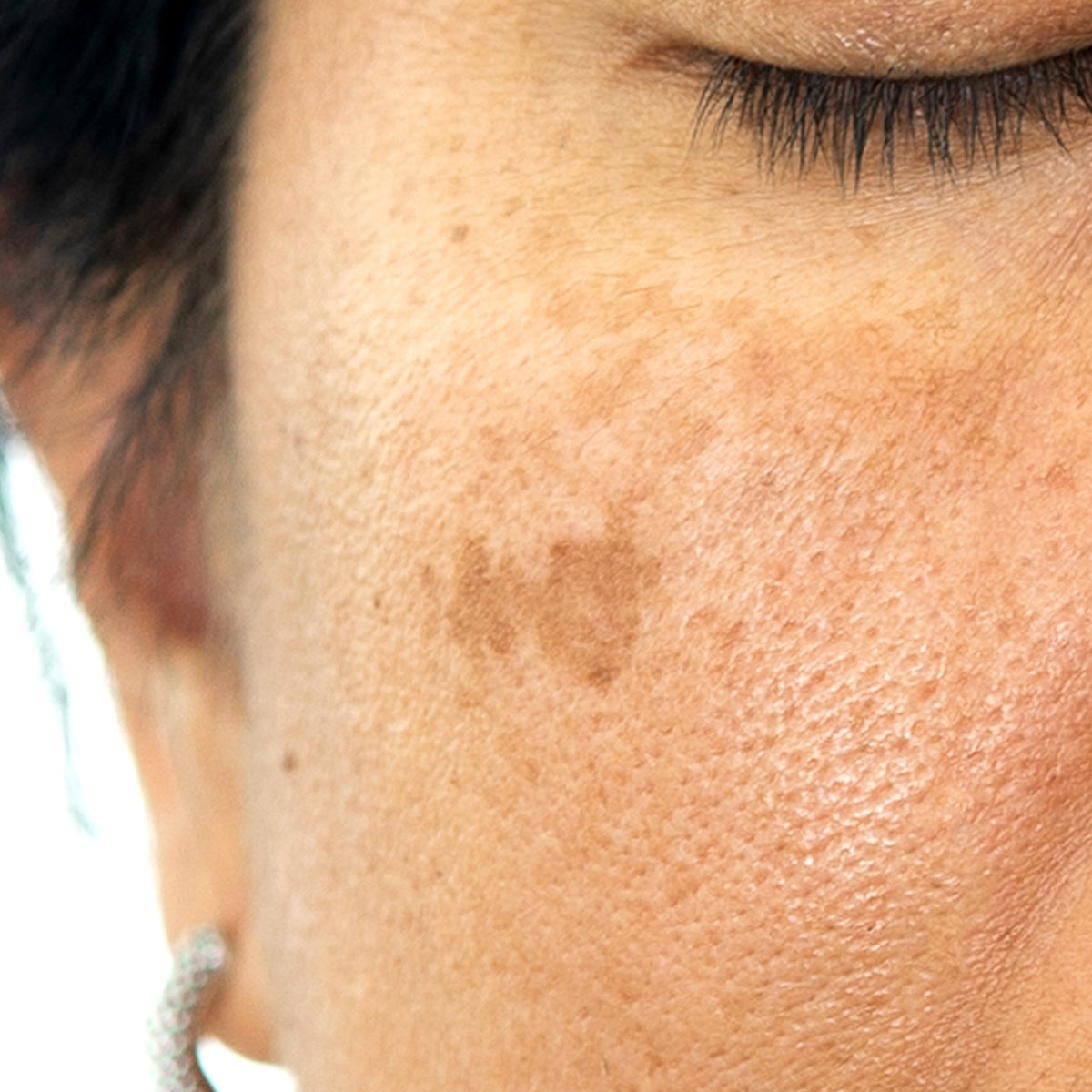 Sun pigmentation treatments | Embassy of Beauty